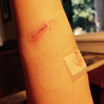 A Sticky Situation: Super Glue in Warfare | War History Online